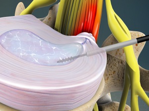 OSS Health | Percutaneous Disc Decompression (Stryker® Disc ...