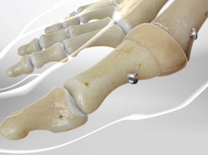 OSS Health | First Metatarsal-phalangeal Joint (MTP) Arthrodesis
