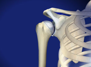 OSS Health | Shoulder Resurfacing