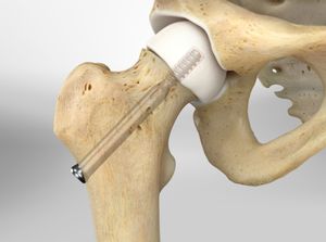 OSS Health | Internal Screw Fixation for Slipped Capital Femoral ...