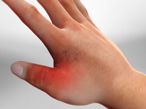 OSS Health | Thumb Ulnar Collateral Ligament (UCL) Injury